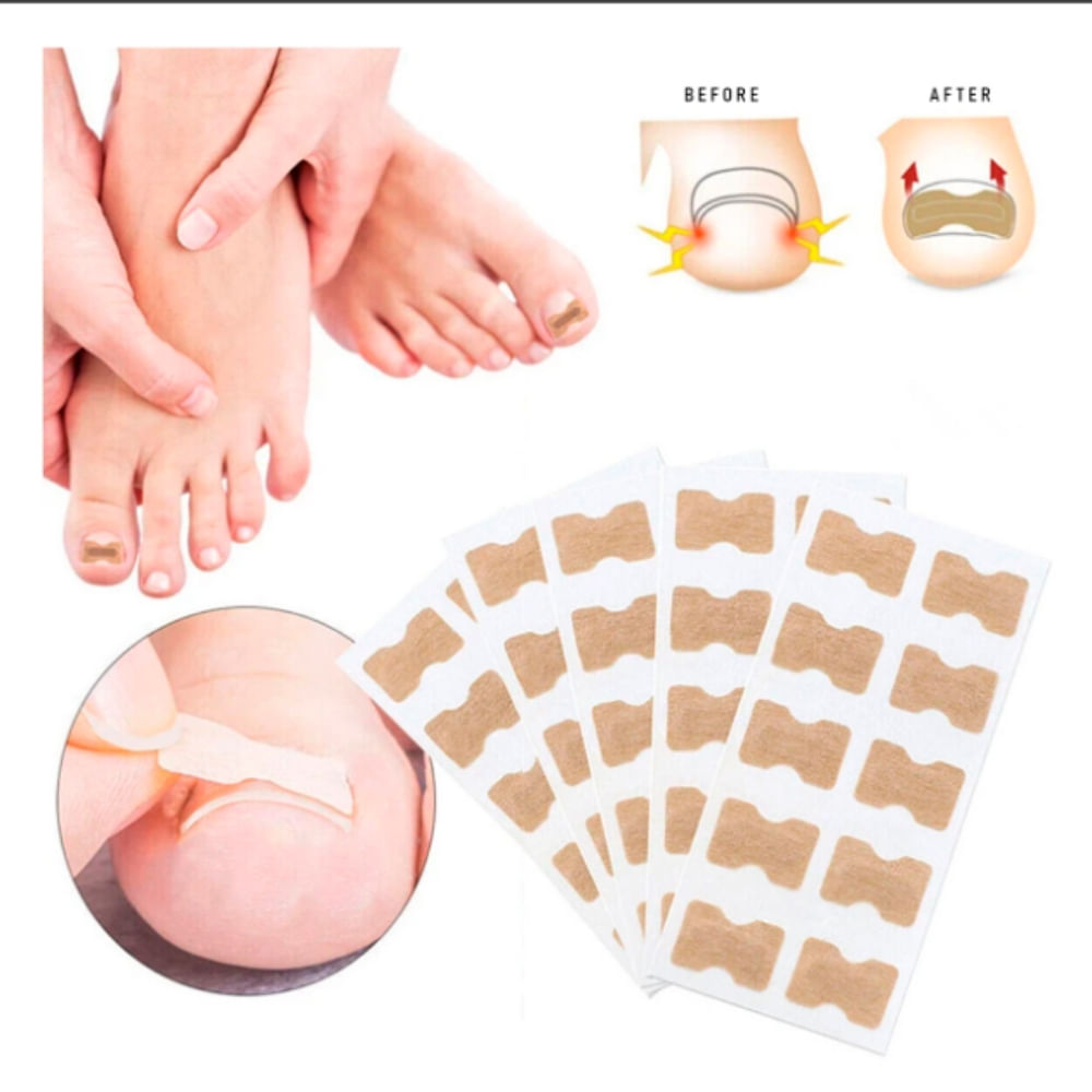 Set Parches Correctores de Uñas Encarnadas, Aliviar Uña Encarnada - Promart